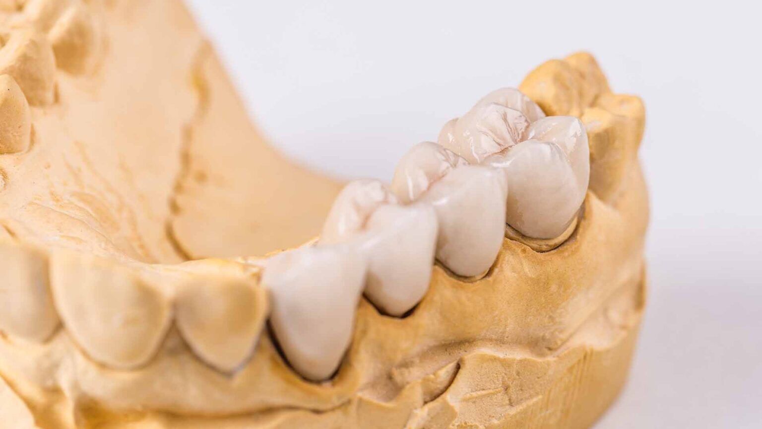 Restauração Onlay: Como é feita e quando indicar?